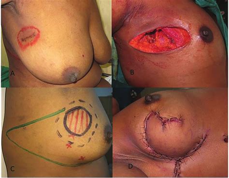 A Scar Of Excision Biopsy For A Right Breast Lump At A Primary Center Download Scientific