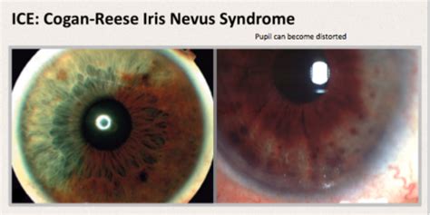 Iris Ac Ocular Disease Flashcards Quizlet