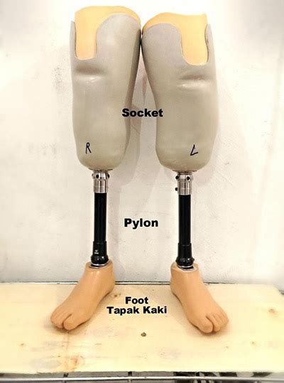 Transtibial Below The Knee Prosthesis Leg Kuala Lumpur Kl Malaysia Selangor Johor Bahru