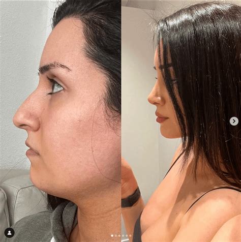 Rhinoplasty Swelling Timeline For Bulbous Nose Thick Skin R