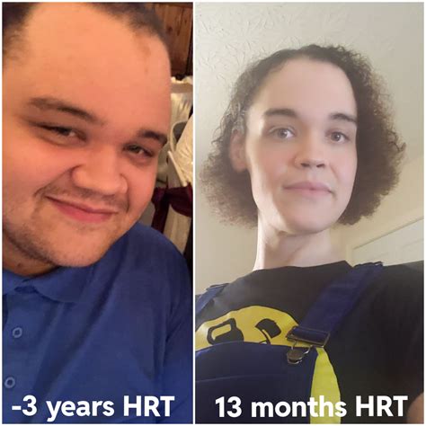 3 Years Hrt Left Vs 13 Months Hrt Right Rtranstimelines