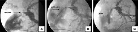 Bismuth Corlette Type Iii Stricture Download Scientific Diagram
