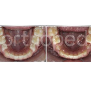 Discrepância positiva OrthopedlearningOrthoped