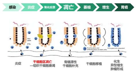 萎縮性胃炎，如何預防癌變？如何治療？ 每日頭條