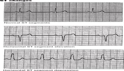 Improve Acs Outcomes By Ecg Assessment Nursing2020 Critical Care Improve Acs Outcomes By Ecg Assessment Nursing2020 Critical Care