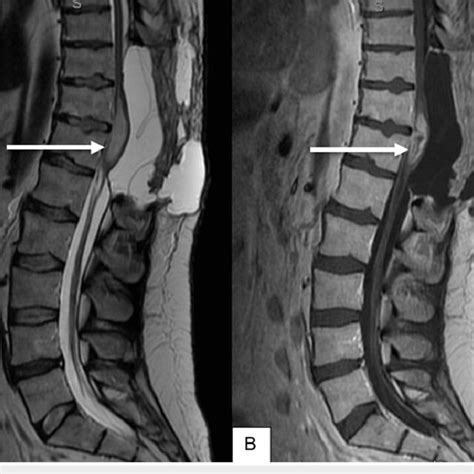 Mri Of The Cervicothoracic Spine Sagittal View A B T2 Weighted And