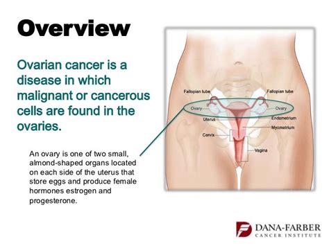 Get The Facts On Ovarian Cancer