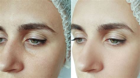 O Que é Peeling Químico Saiba Para Que Serve