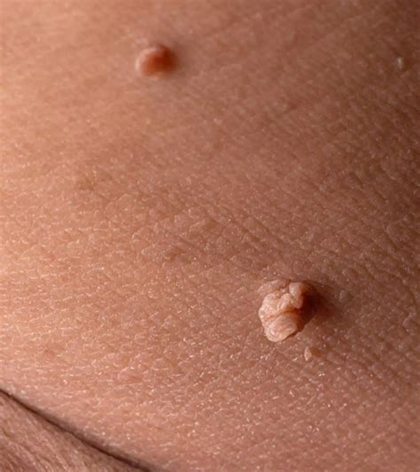 Genital Skin Tags