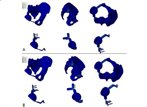 Stress Distribution Of The Pelvis Reconstructed Using A Prosthesis With Download Scientific