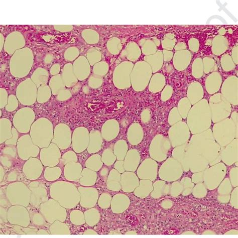 Above Biopsy Of Skin Lesions Hande Leukocytoclastic Vasculitis Of
