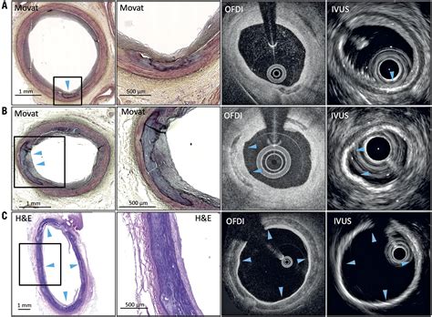 Intravascular Imaging And Histological Correlates Of Medial And Intimal Calcification In