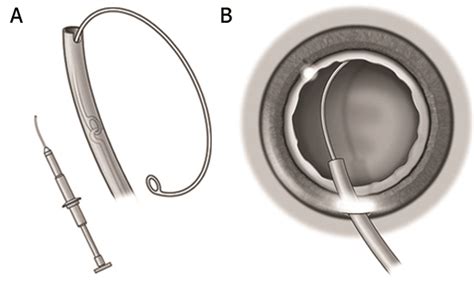 Capsular Support Devices Eyewiki