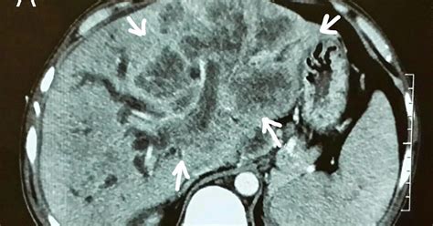 ERCP EGD A Very Large Intrahepatic Cholangiocarcinoma