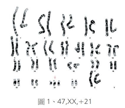 染色體異常台灣現況研究 台灣精準兒童健康協會
