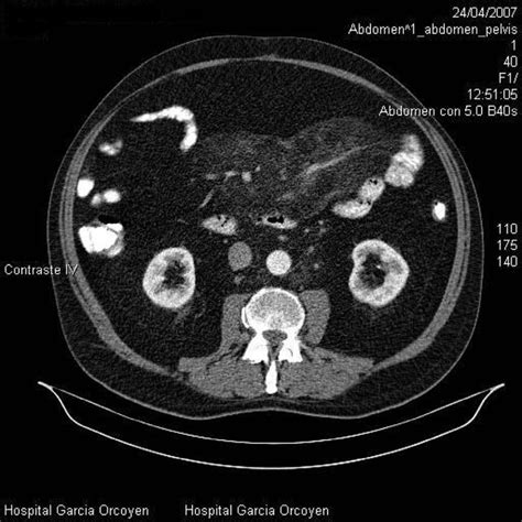 Pdf Paniculitis Mesentérica A Propósito De Un Caso