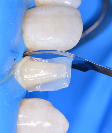 Direct Anterior Composite Myzerodonto