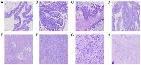 Ovarian Tumor Histiology