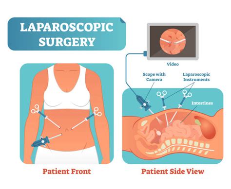 Laparoscopic Surgery Illustrations Royalty Free Vector Graphics And Clip