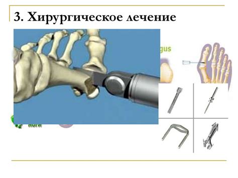Плоскостопие. Причины, виды, лечение и профилактика - презентация онлайн