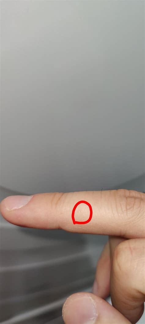 Very Small Skin Colored Bumps On Fingers Rmedical