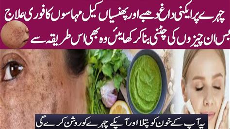 Face K Dano Ka Ilaj Face K Dane Khatam Karne Ka Tarikaremove Pimples
