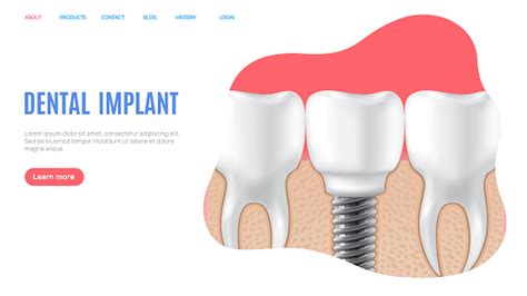 정상적인 건강한 치아와 치과 임플란트 구조 위의 잇몸에 보철물을 가진 인간의 턱 건강관리와 의술에 대한 스톡 벡터 아트 및 기타 이미지 건강관리와 의술 금속 나사