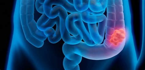 Sintomas CÂncer Intestino Fase Inicial Veja Sintomas E Sinais De
