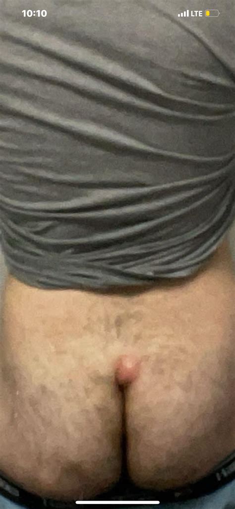 Pilonidal Drainage Rpilonidalcyst