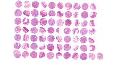 Es701a Esophagus Cancer Tissue With Matched Adjacent Normal Tissue （nat