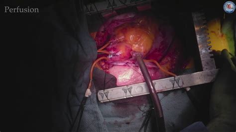 Sternotomy For Lung Transplantation A Description Of Technique Youtube