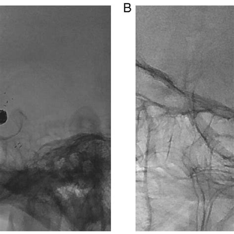 Dsa 5 Years After First Coil Embolization A Native And B Dsa