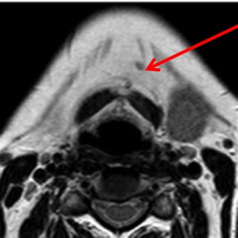 Alveolar Nerve Recess References Radiología Centro De Diagnóstico