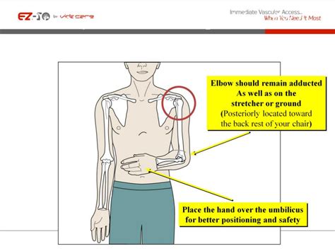 Io Intraosseous Line Ub Pem Procedures