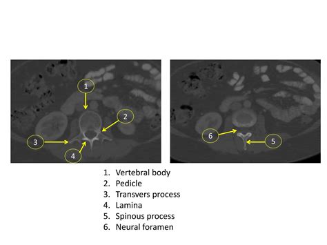 1 Radiological Anatomy Of Spineppt By A Doctor Ppt
