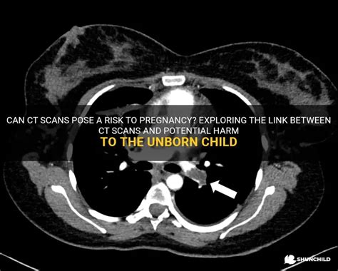 Can Ct Scans Pose A Risk To Pregnancy Exploring The Link Between Ct