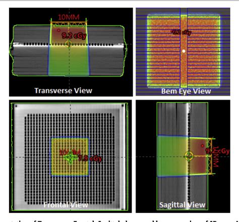 Figure 4 From Validation Of Dosimetric Leaf Gap Dlg Prior To Its Implementation In Treatment