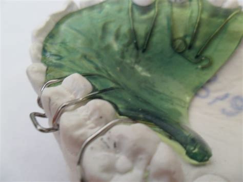 Chrome Cobalt Dentures Dental Tech Lab