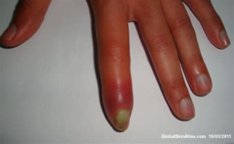 Global Skin Atlas Diagnosis Detail