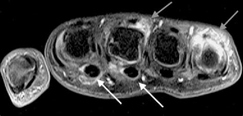 Mri Of The Left Hand Shows T1 Post Contrast With Fat Saturation Note