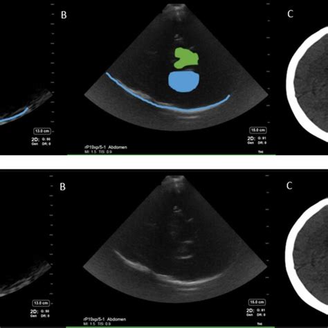 Thalamic Tumor Creating A Hyperechoic Signal Similar To Intracerebral