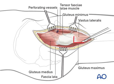 Direct Lateral Approach To The Proximal Femur