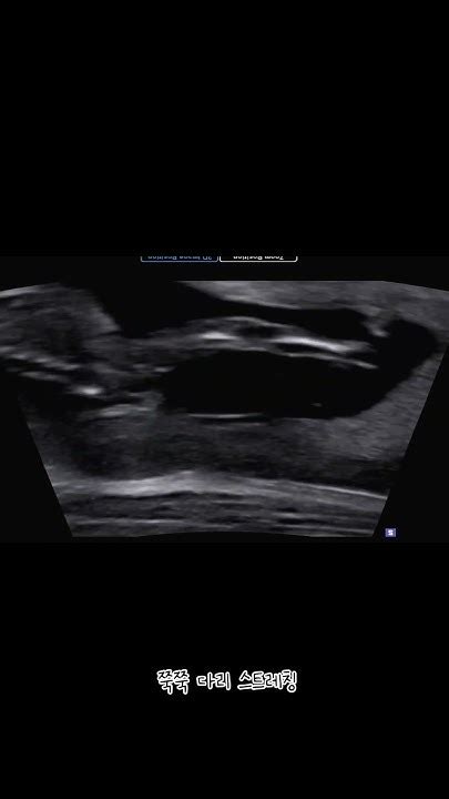 14주 0일 초음파 성별은 아들이냐 딸이냐 뭐든 좋지만 궁금해🤨 초음파성별 Youtube