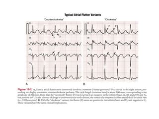 Atrial Fib And Atrial Flutter Pptx