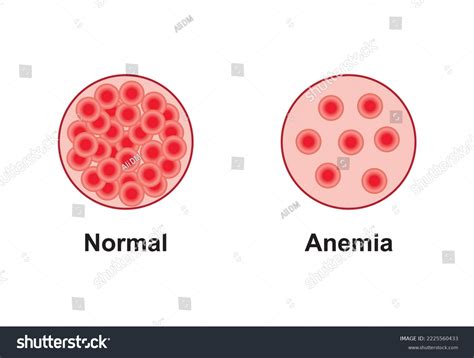 Thalassemia Major Over 22 Royalty Free Licensable Stock Vectors