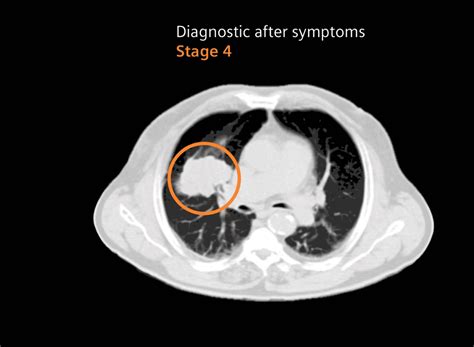 Lung Cancer Cat Scan