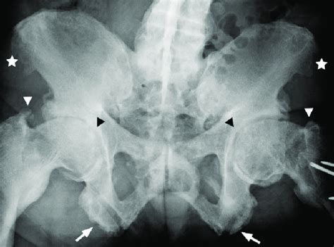 Radiographic Imaging Of The Lumbar Spine And Pelvis Of A 54 Year Old Download Scientific