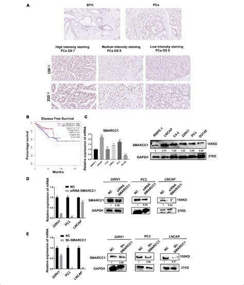 Smarcc1 Is Downregulated In Pca Tissues And Correlates With Poor