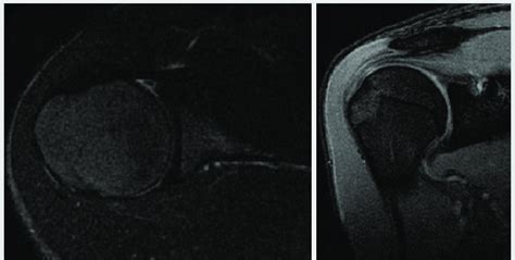 Fat Suppressed T2 Weighted Axial A And Coronal Oblique B Magnetic