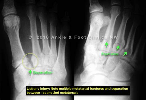 Lisfranc Injuries Integrative Foot And Ankle Centers Of Washington